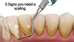 Article: 5 SIGNS YOU NEED A DENTAL SCALING