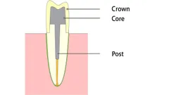 Article: Post and core Procedure