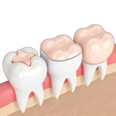 Article: INLAYS AND ONLAYS -indirect restoration.
