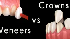 Article: VENEERS VS CROWNS (pros and cons)